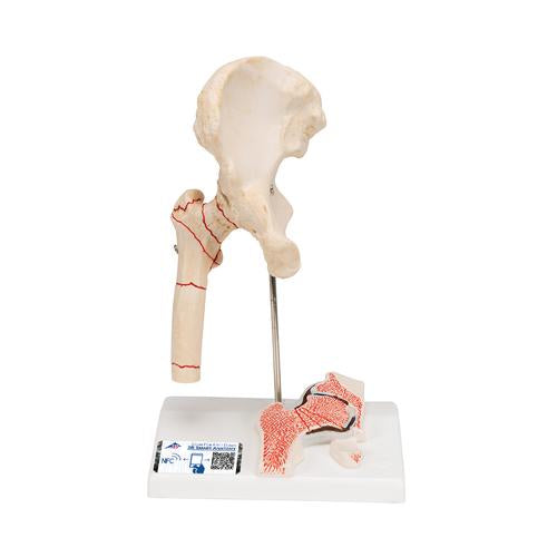 Human Femoral Fracture & Hip Osteoarthritis Model - 3B Smart Anatomy ...