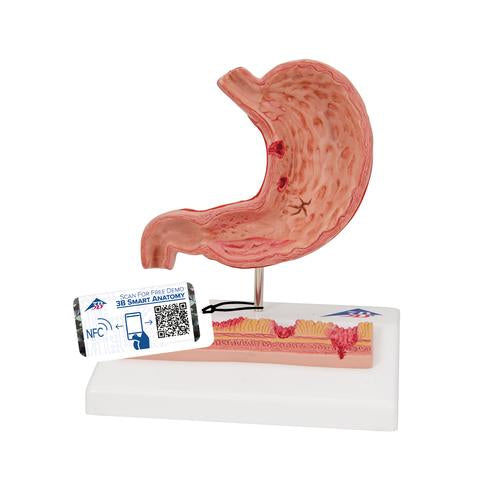 Human Stomach Section Model with Ulcers - 3B Smart Anatomy — Health ...
